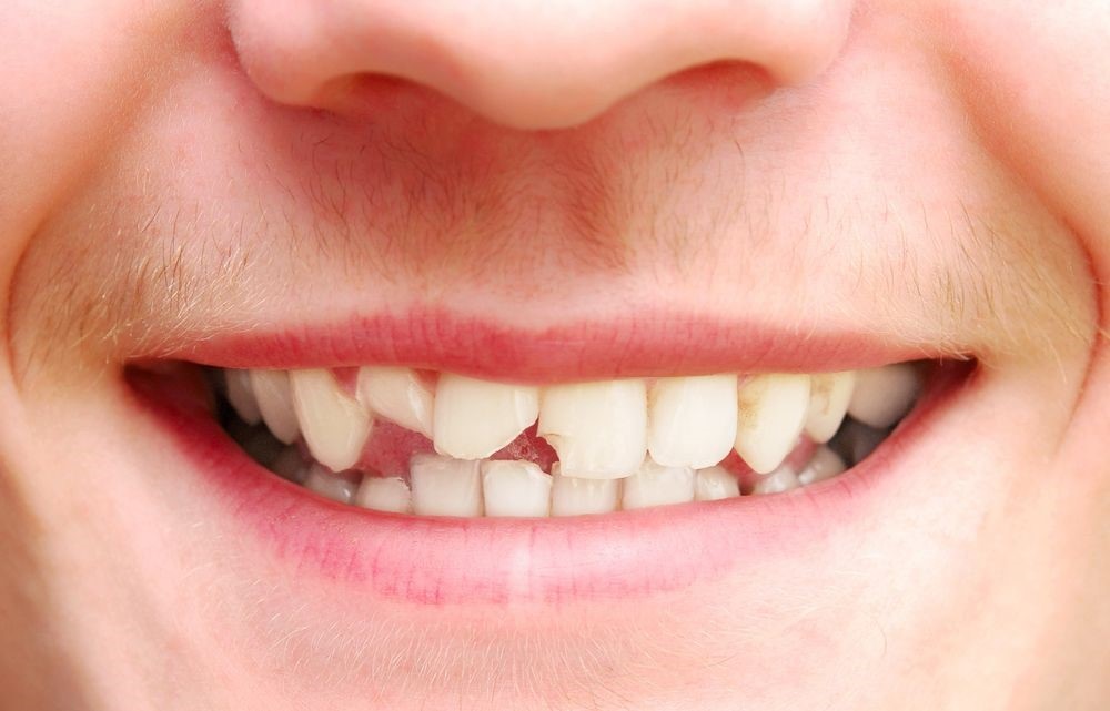 Chipped Teeth From Grinding