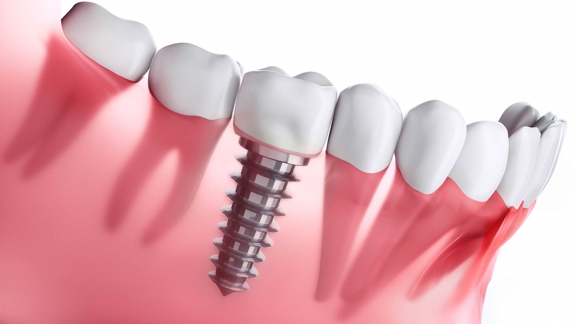 Tooth Replacement Options - Fraser Dental